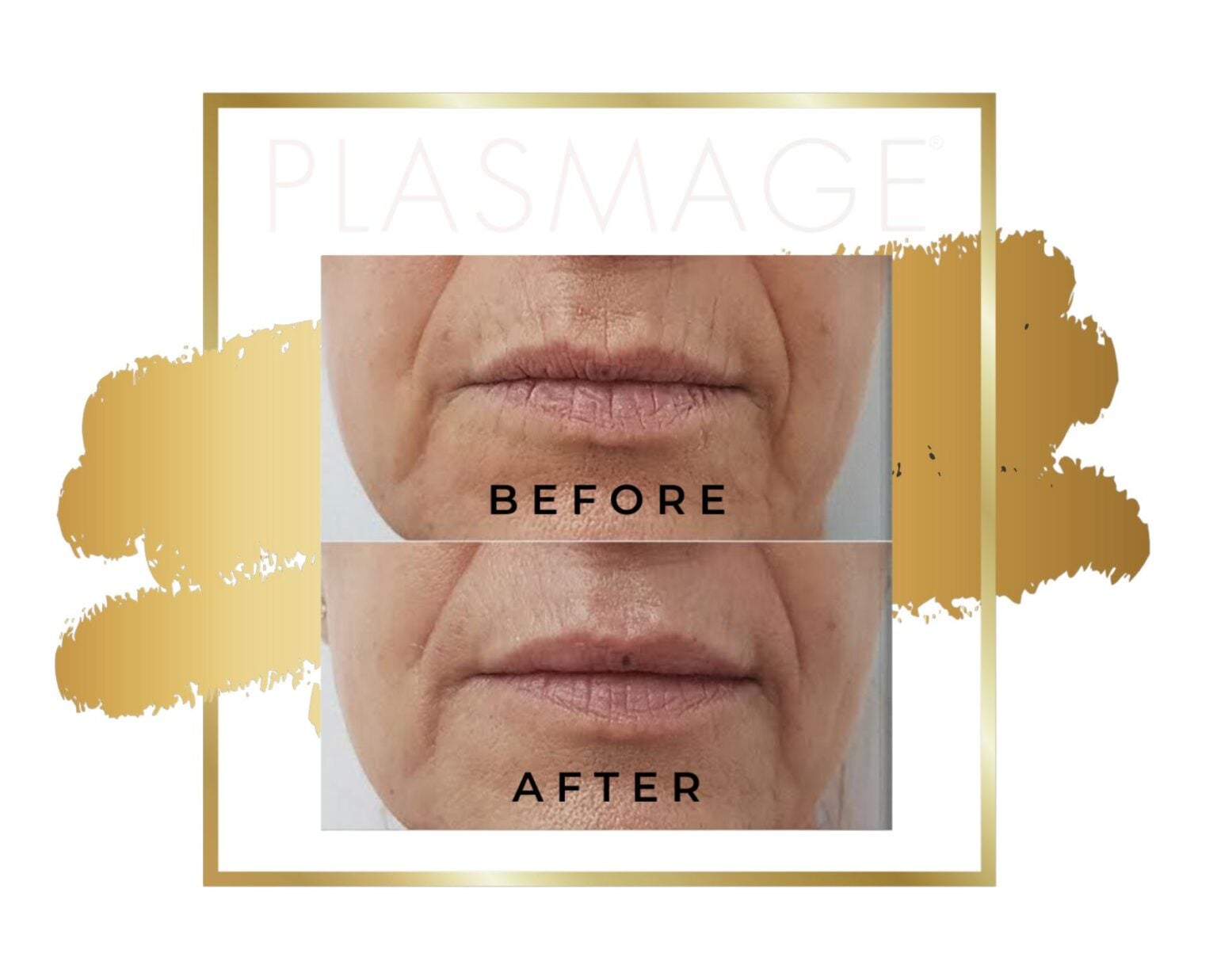 Plasmage - Axis Wellness & Esthetique
